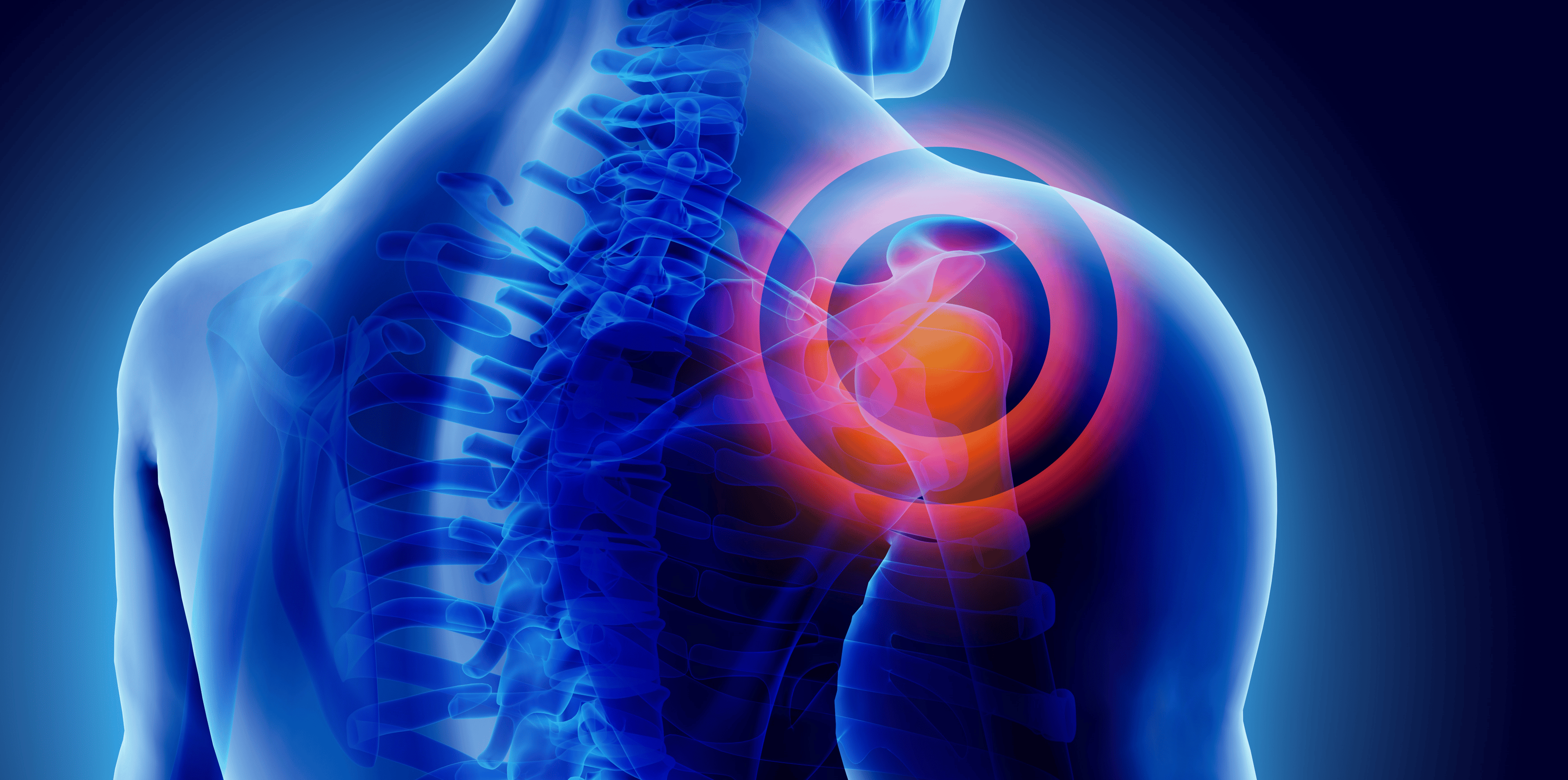 AAOS Shoulder & Elbow Registry Launches Shoulder Arthroplasty ...